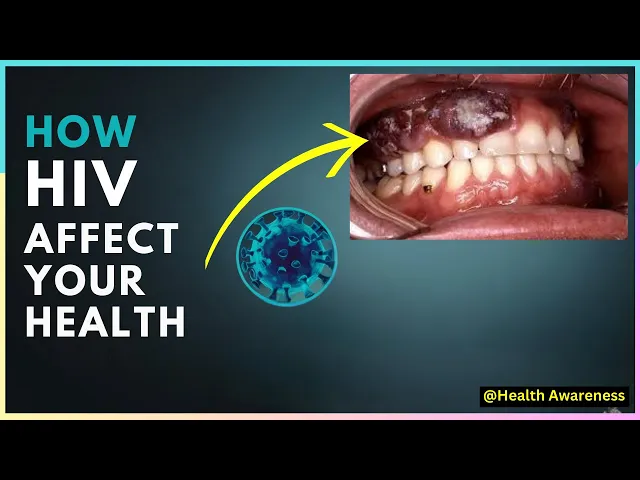 How Does HIV Affect Your Health? Key Challen... | Open Video