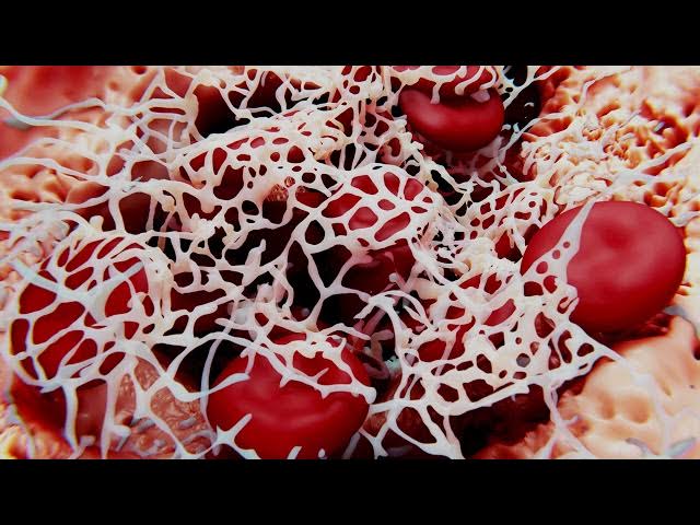 Blood Clots in Legs: Recognizing Symptoms an... | Open Video