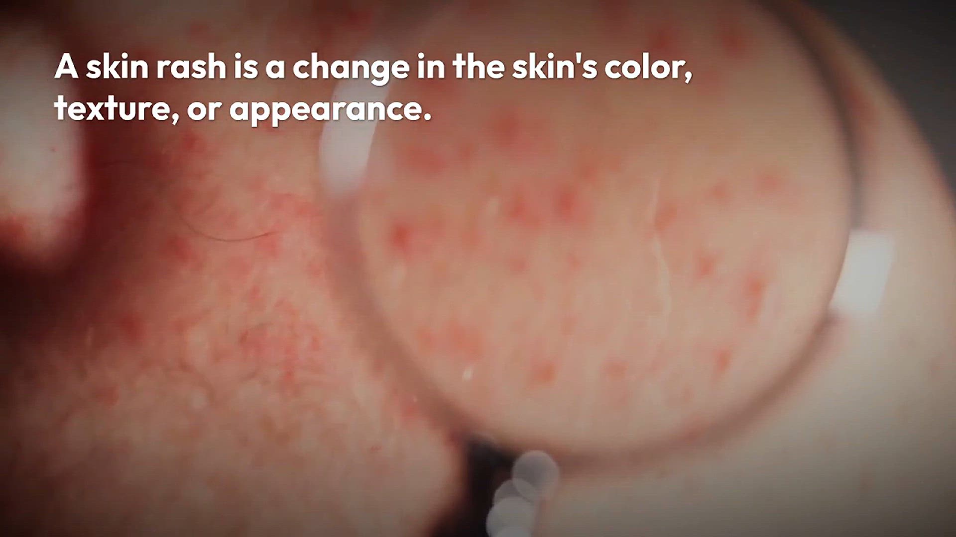Understanding Skin Rash Triggers | Humix Video