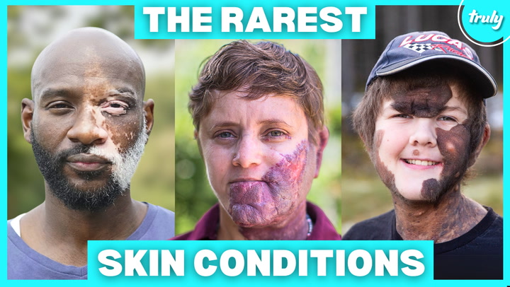 The World's Rarest Skin Conditions | BOR... | Open Video
