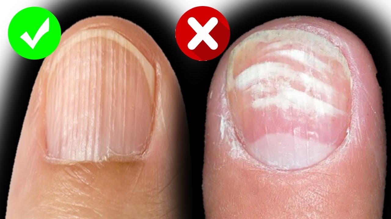Ridges In Nails - Causes Of Nail Ridges And How To Treat ...