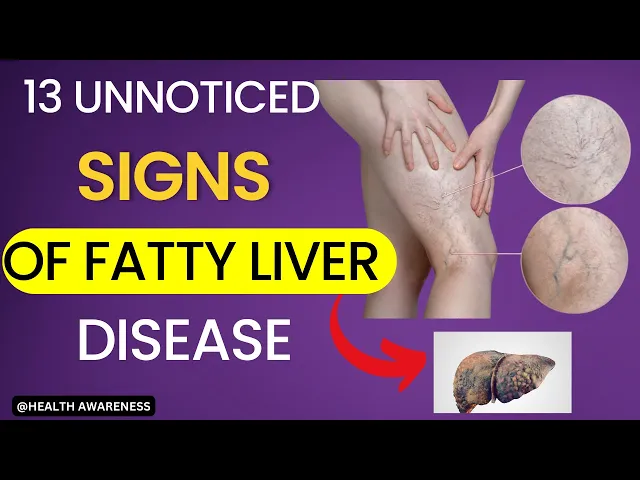13 Unnoticed Signs of Fatty Liver Disease ||... | Open Video